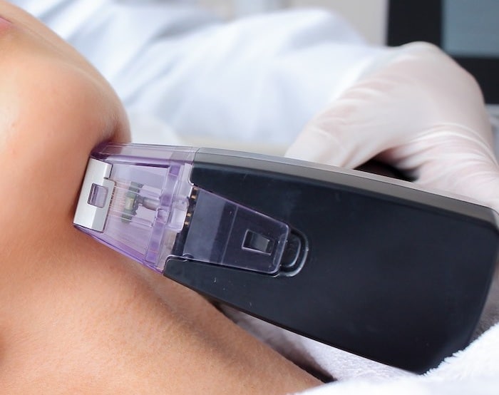 RF Microneedling Toronto, Facey & Neck RF Microneedling Downtown